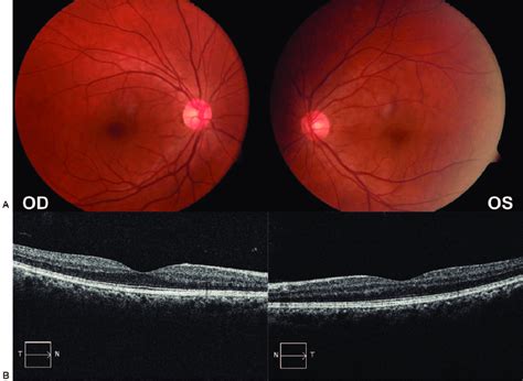 Normal Optic Disc
