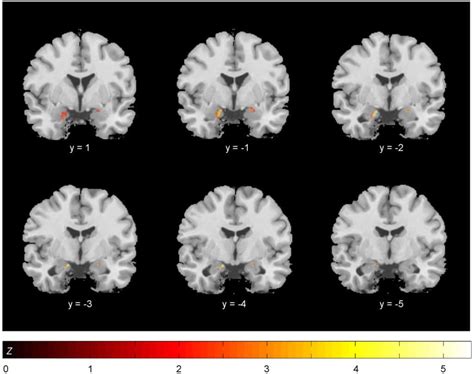Structural But Not Functional Neuroplasticity One Year After Effective