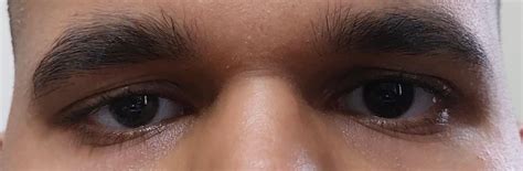 Ptosis Brow Ptosis Blepharoplasty R Plasticsurgery