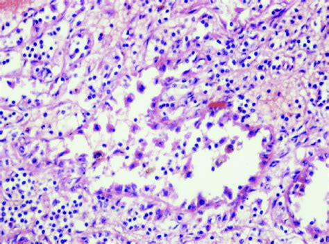 A Higher Power View Of The Lesion Demonstrates The Characteristic