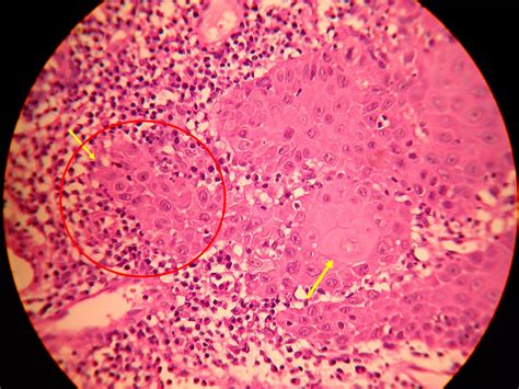 Podoplanin And Its Role In Diagnosis Of Cancer Invasion Ppt