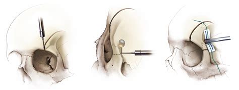 Orbitozygomatic Craniotomy The Neurosurgical Atlas