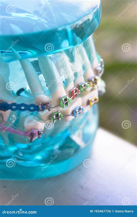 Classic Dental Metal Orthodontics With Colored Hooks Stock Photo Image Of Dentistry Care