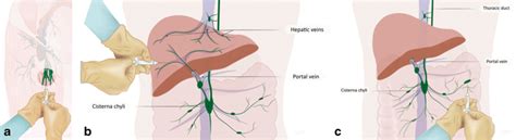 Us Guided Needle Access For Mr Lymphangiography A Schematic Shows