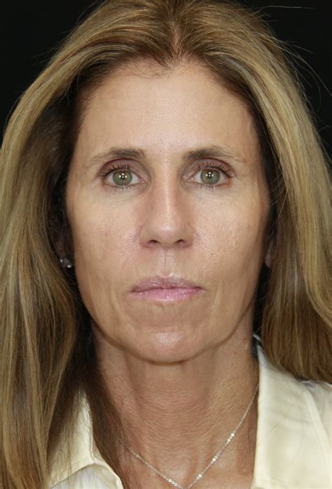 Palm Beach Facial Plastic Surgery