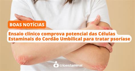 Células estaminais do cordão umbilical para tratar psoríase