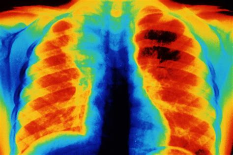 Most Common Infectious Diseases In The Us In Pictures