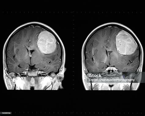Mri는 뇌 표시중 종양 뇌종양에 대한 스톡 사진 및 기타 이미지 뇌종양 Mri 스캐너 Mri 스캔 Istock