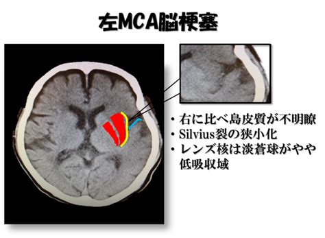 脳画像のctはここをみろ！！ctの見方から脳出血と脳梗塞の違いまで徹底網羅！ リハアイデア