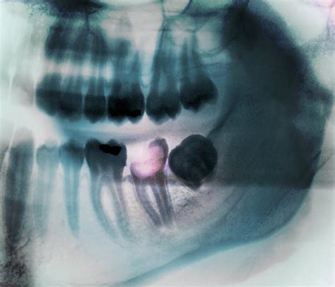 Tooth Decay X Ray Photograph By Zephyr Pixels