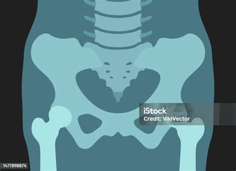 Pelvis X Ray Picture Human Anatomy Skeleton Bone Scanning Internal