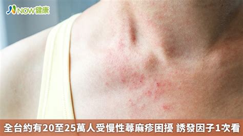 全台約有20至25萬人受慢性蕁麻疹困擾 誘發因子1次看 蕃新聞