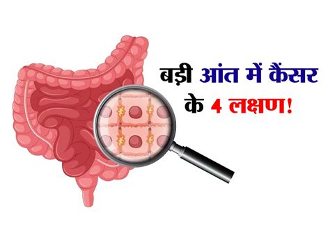 पुरुषों में बड़ी आंत के कैंसर के 4 लक्षण