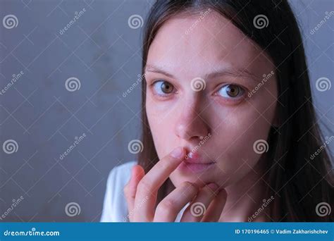 Portrait Of Woman Smears Her Sore On Lip With Ointment From Herpes