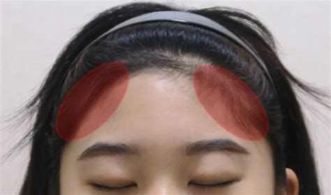 좁은이마제모 뽑지말고 영구적으로 네이버 블로그