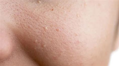 3 Nguyên Nhân Chính Gây Nổi Mụn Li Ti Trên Mặt Và Cách Xử Lý Actidem