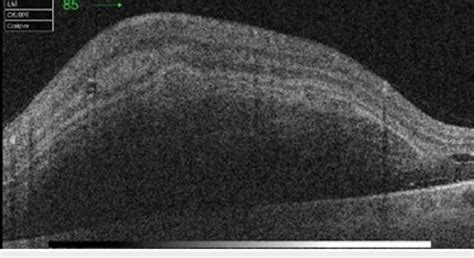 Left Eye OCT Scan Shows Massive Sub Retinal And Intraretinal Download Scientific Diagram