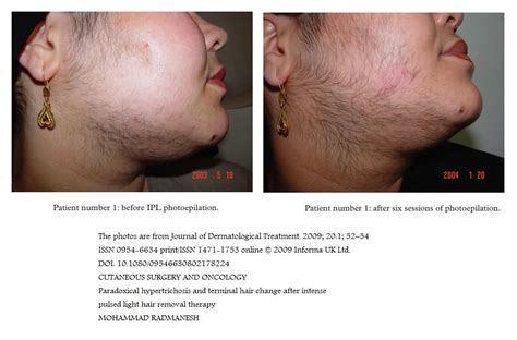 Hypertrichosis Treatment Before And After