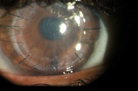 Taher Eleiwa On Linkedin Corneal Graft Rejection