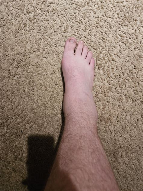 Dislocated Ankle Or Sprain Rmedicaladvice