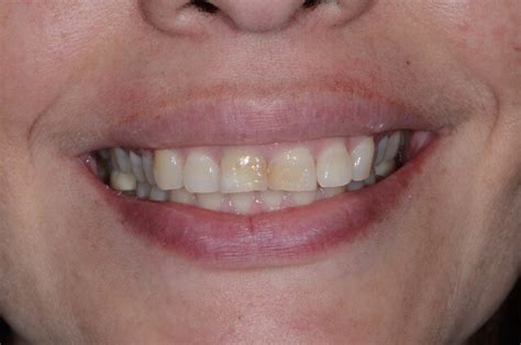 Dental Enamel Hypoplasia