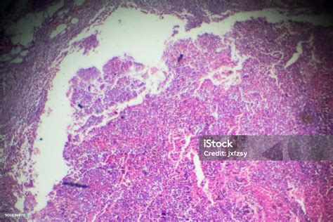 Acute Phlegmonous Appendicitis Pathology Under Light Microscopy Stock