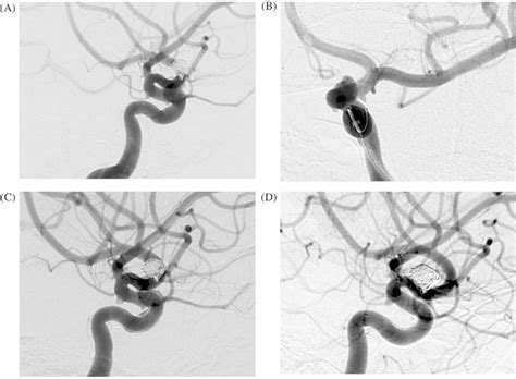A Lateral Angiogram Of The Left Internal Carotid Artery A Patient