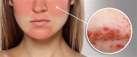Leczenie trądziku różowatego Portal Dermatologiczny