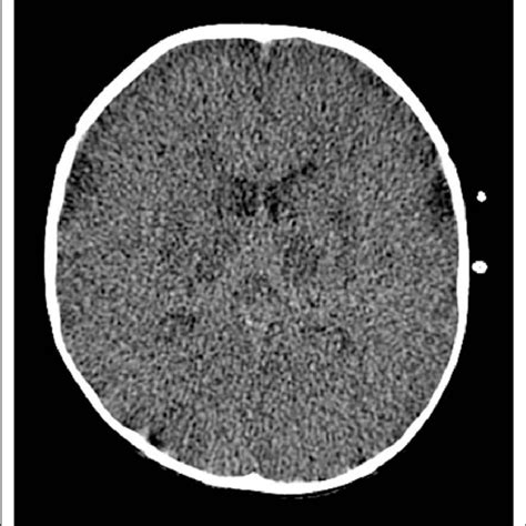 Noncontrast Computed Tomography Scan Of The Brain Day Of Admission