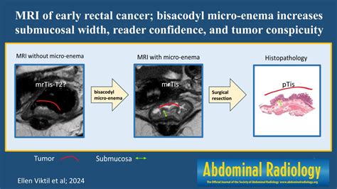Updates On Staging Of Early Rectal Cancer