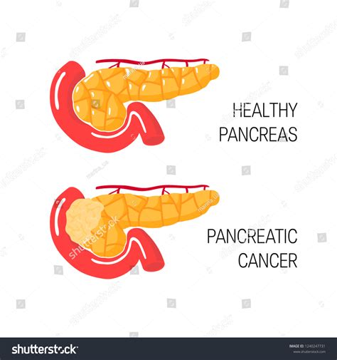 Pancreatic Cancer Concept Medical Vector Illustration Stock Vector