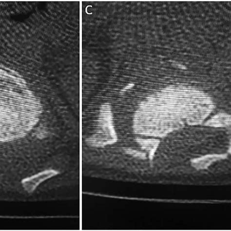 Spine Radiograph Showing A Compression Fracture At T And L Download Scientific Diagram