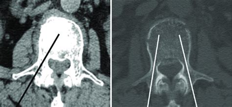 A The Unilateral Transpedicular Simultaneous Puncture B The