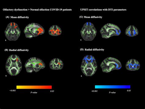 White Matter Abnormalities In Olfactory Dysfunction Patients Compared Download Scientific