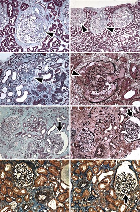 Optic Microscopy The Arrowhead Shows Fsgs Glomerulus And The Arrow