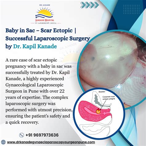 Ectopic Pregnancy Surgery Dr Kapil Kanade Pune Blog