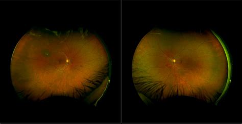 California Choroidal Nevus Rg Af