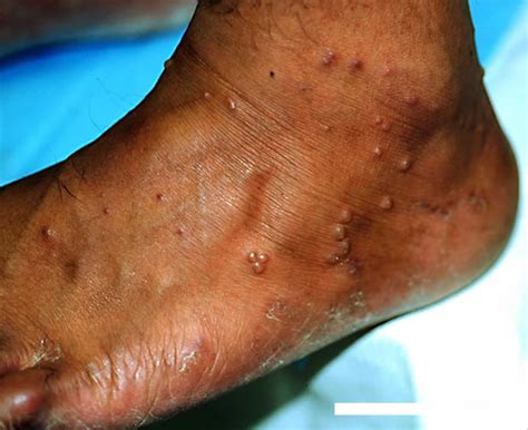 Id Reaction Causes Signs Symptoms Diagnosis And Id Reaction Treatment