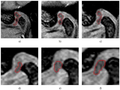 result of segmentation of tmj in six selected slices a f 1 6 slice