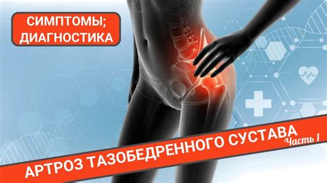 АРТРОЗ ТАЗОБЕДРЕННОГО СУСТАВА СИМПТОМЫ И ДИАГНОСТИКА Часть 1 Youtube