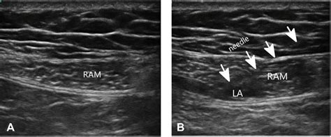 Figure 1 From Ultrasound Guided Rectus Sheath Block Combined With