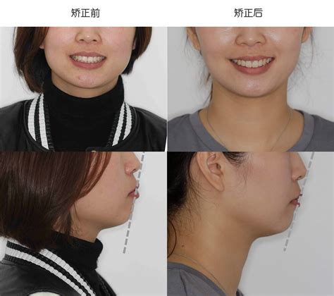 牙齿咬合错位脸歪图 正常的上下牙咬合图 伤感说说吧