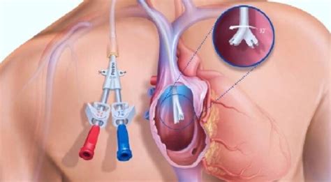 Permcath And Tunneled Catheter Insertion In Moshi Pune