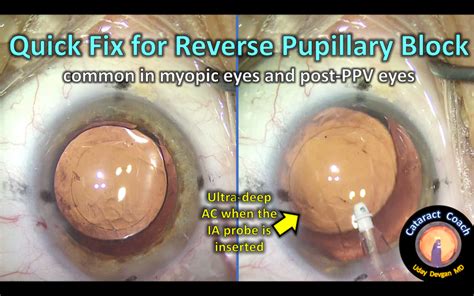 Quick Fix For Reverse Pupillary Block Cataract Coach