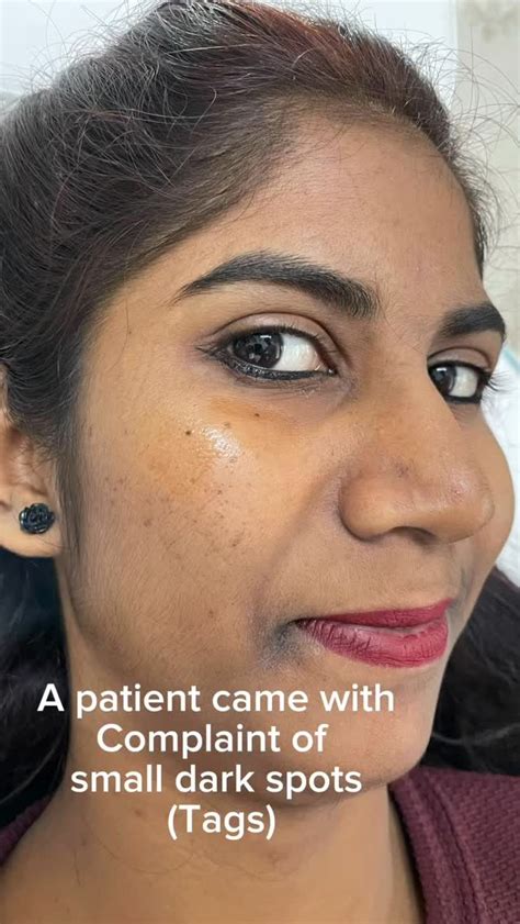 Dr Kiran Swapnil Bhosale Nurtureskinclinic • Instagram Photos And Videos