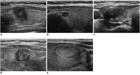 Does A Solid Thyroid Nodule Mean Cancer Cancerwalls