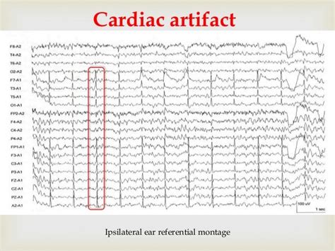 Eeg Artifact