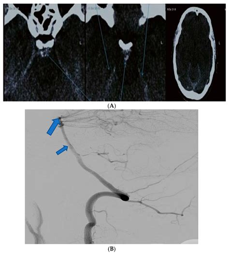 Interpeduncular Cistern Hemorrhage