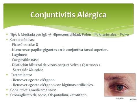 SINDROME DE OJO ROJO Pontificia Universidad Javeriana Oftalmologa