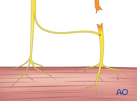 Ulnar And Median Nerve Lesions